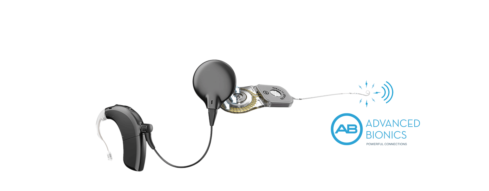 Advanced Bionics Cochlear Implants | 20dB Hearing